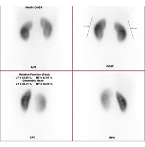 핵의학 신장 영상 [DMSA] 검사- Renal scan (Tc-99m DMSA) | 영상검사항목 | 영상검사 | 검사안내 ...
